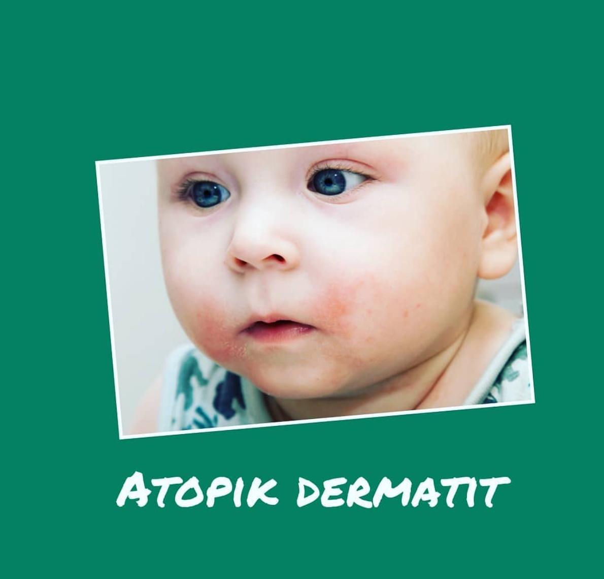 ATOPİK DERMATİT (Egzama) – Antalya Dermatoloji